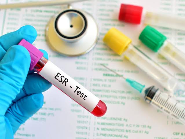 ESR Testing: What to Expect and How It’s Done – Rising Kashmir